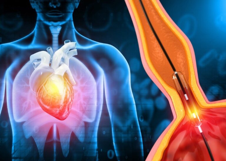 Case Study: PTCA Balloon Dilation Catheters - Biocoat Incorporated